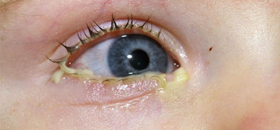 Olhos: excesso de remela pode indicar problemas - oreporter.net